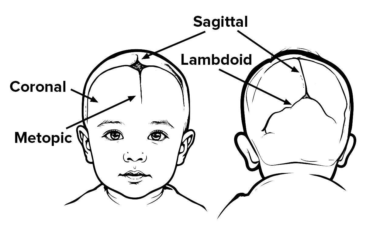 The Pediatric Craniofacial Program at UBNS | UB Neurosurgery